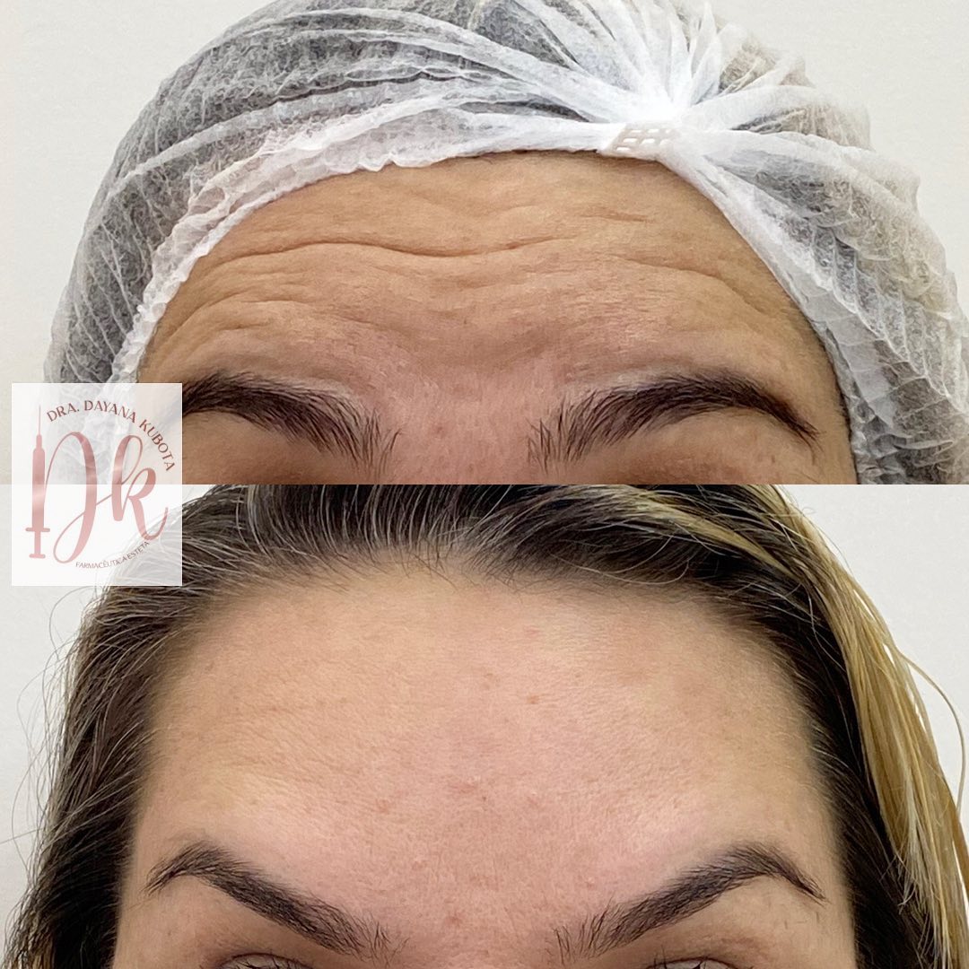 Botox - Dra. Dayana Kubota - Agende sua avaliação